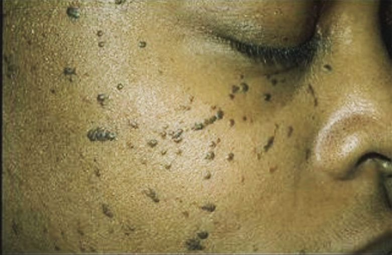 What are skin tags? - herald