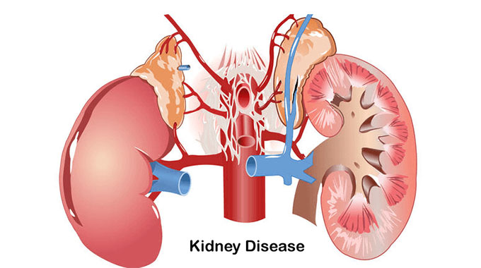 Kidney disease: A silent killer that demands affordable treatment for ...