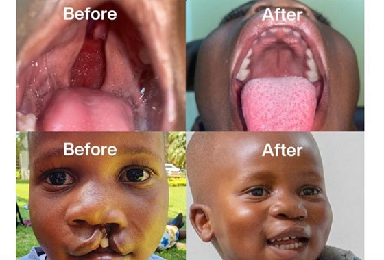 Cleft Palate Surgery